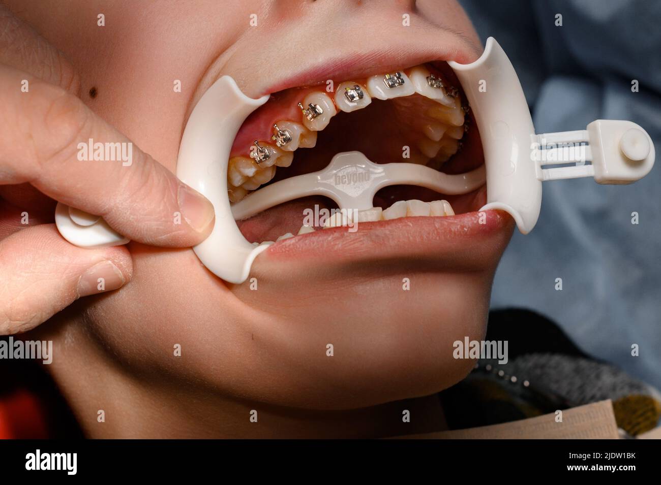 Ivano-Frankivsk, Ukraine February 3, 2022: installation of braces with ...