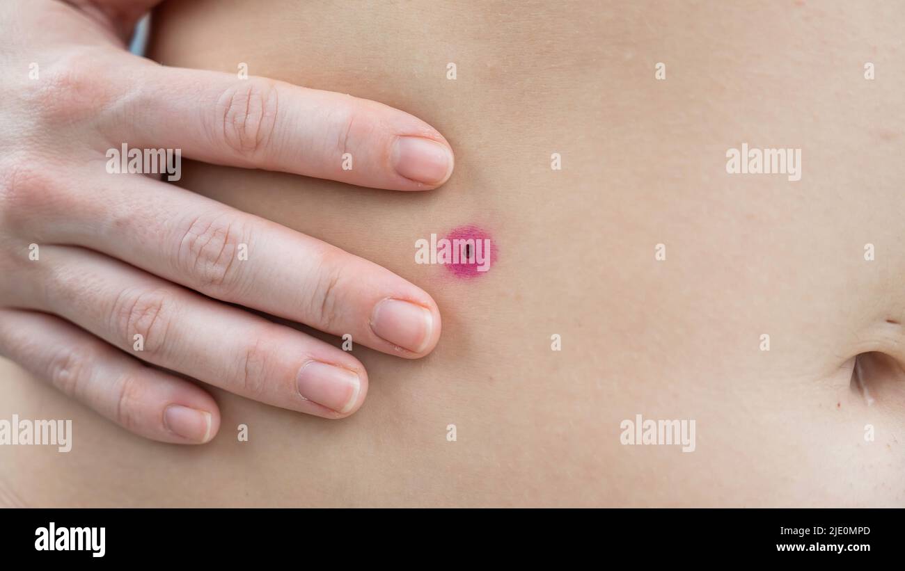 Close-up of a removed wart on a woman's abdomen. Human papillomavirus ...