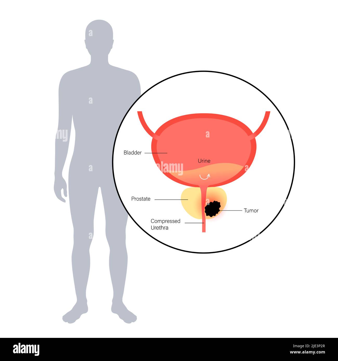 Prostate cancer, illustration Stock Photo - Alamy