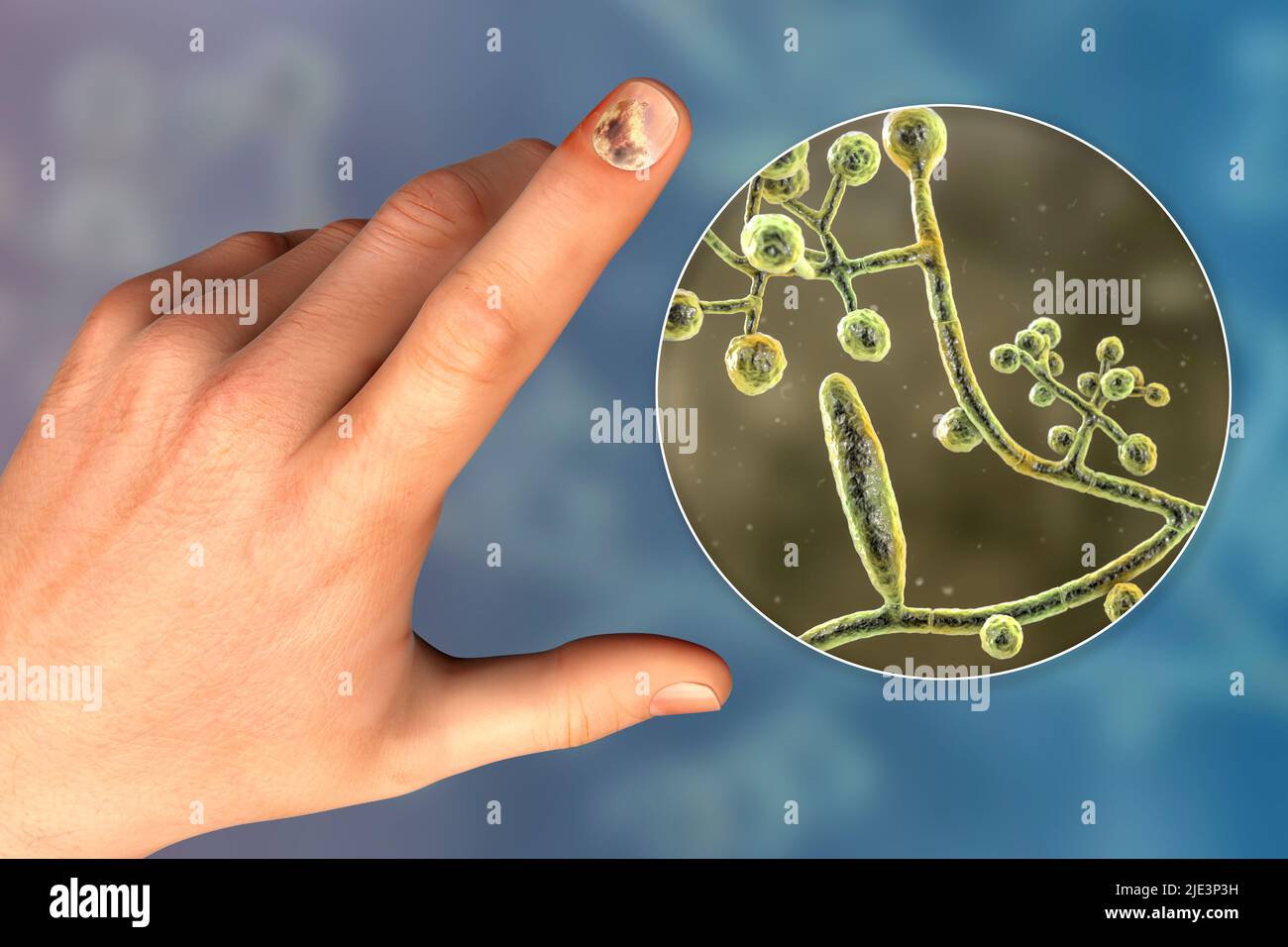 Illustration of a fungal nail infection showing human hand with ...