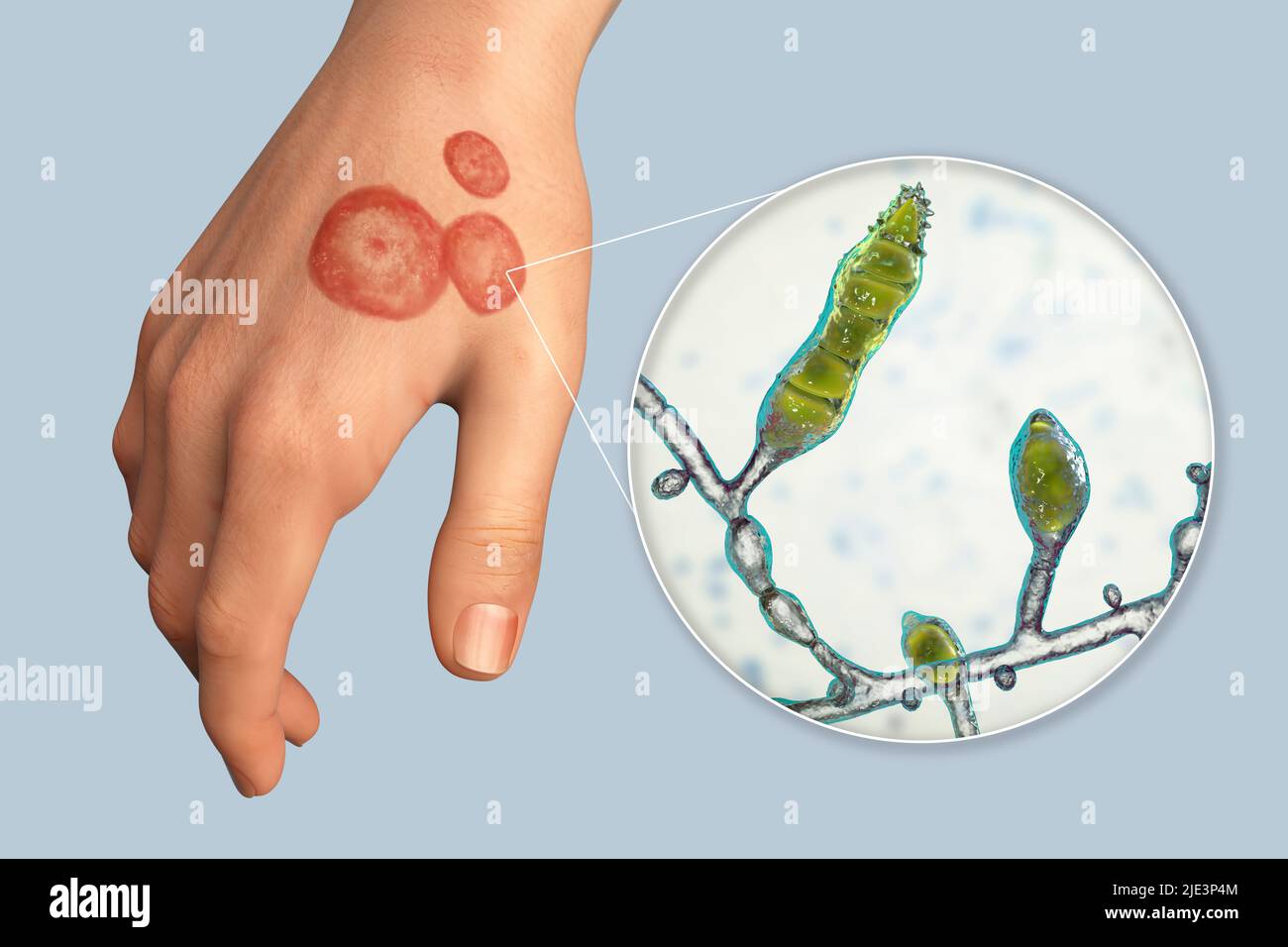 Tinea manuum hi-res stock photography and images - Alamy