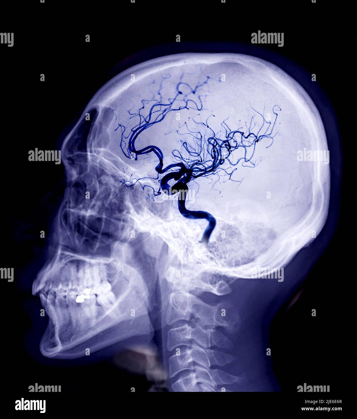 Angiogram x ray head hi-res stock photography and images - Alamy