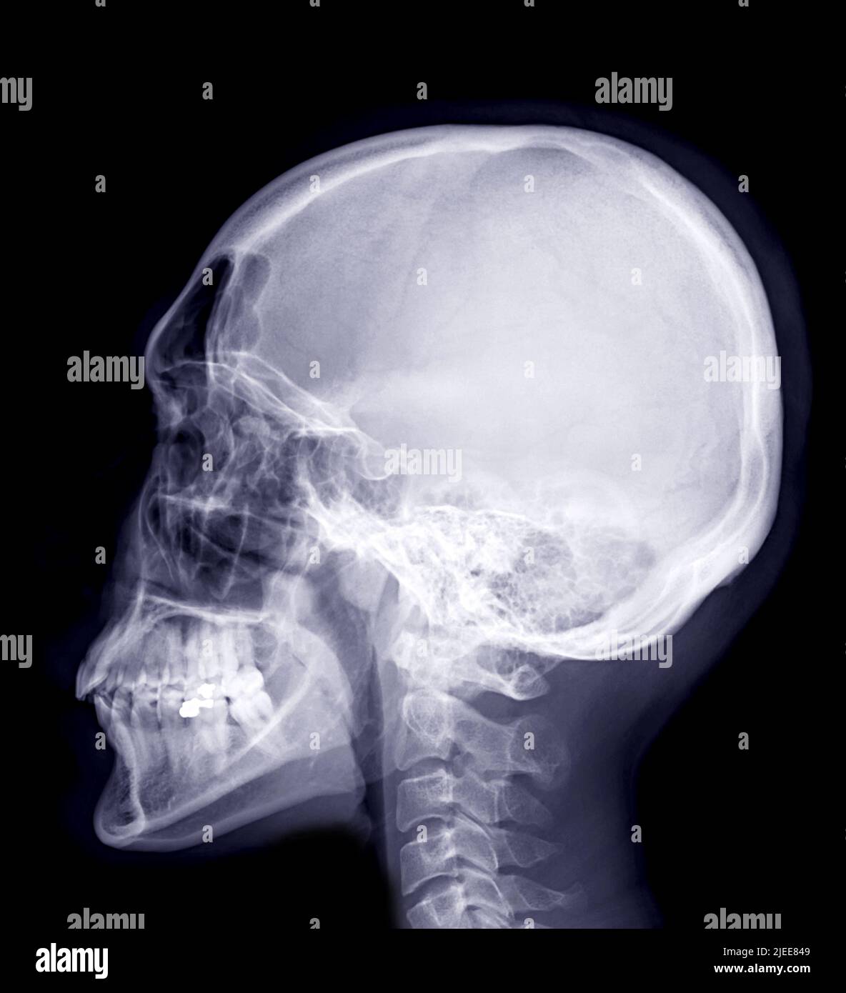 Skull x-ray image of Human lateral view isolated on Black Background ...