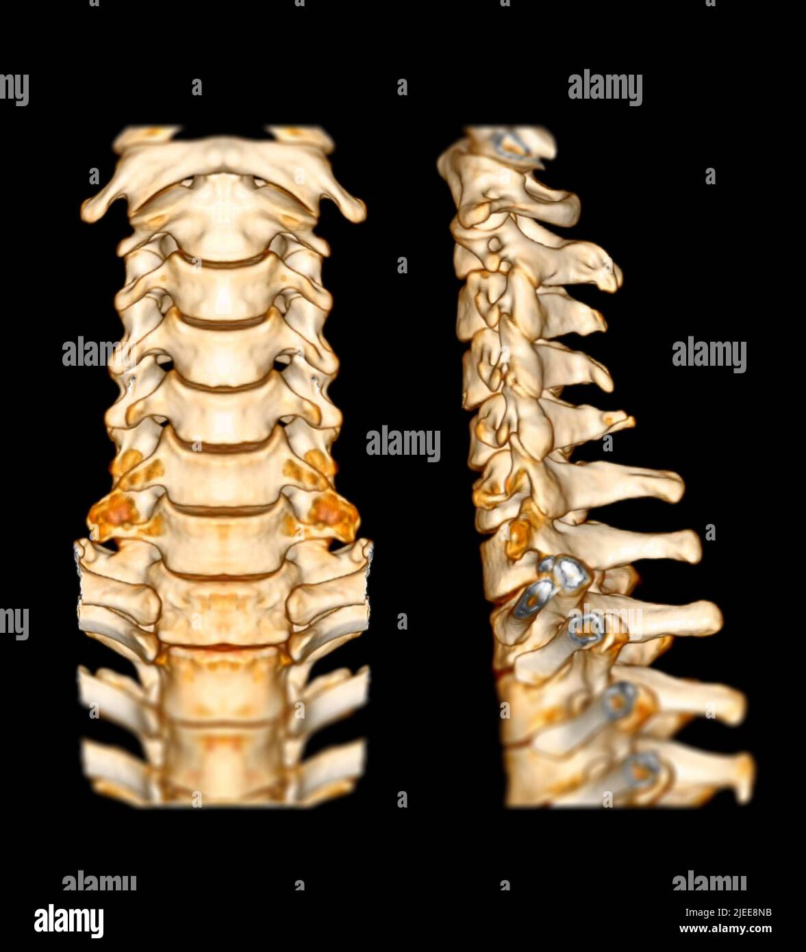 CT SCAN of Cervical Spine ( C-spine ) patient trauma case 3D rendering ...