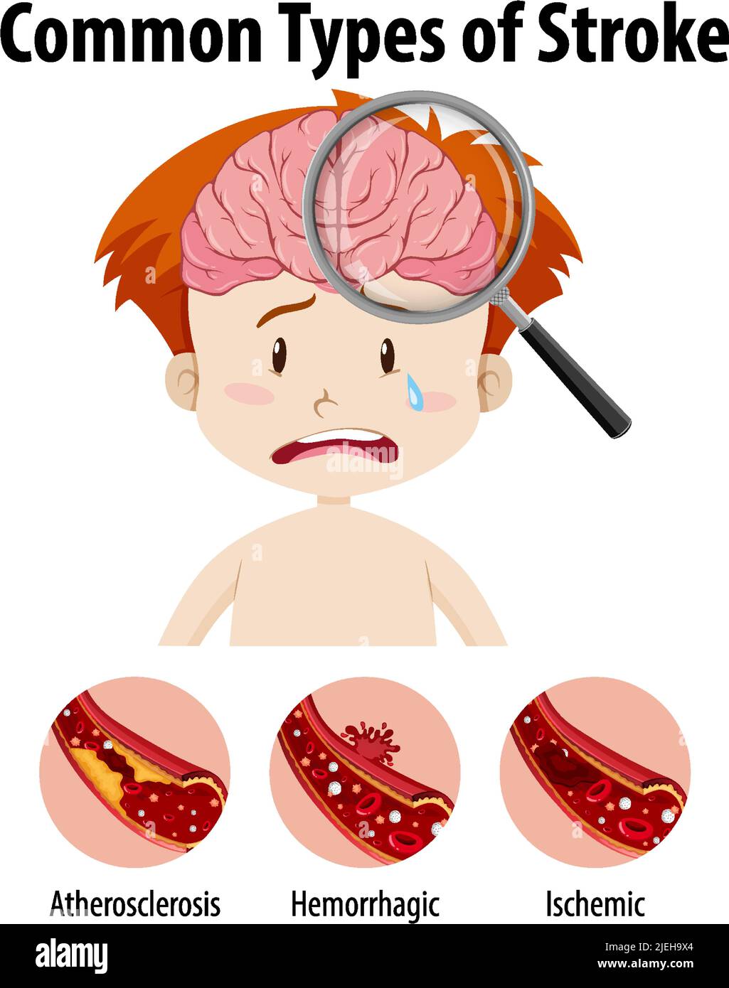 Human with common types of stroke illustration Stock Vector Image & Art ...