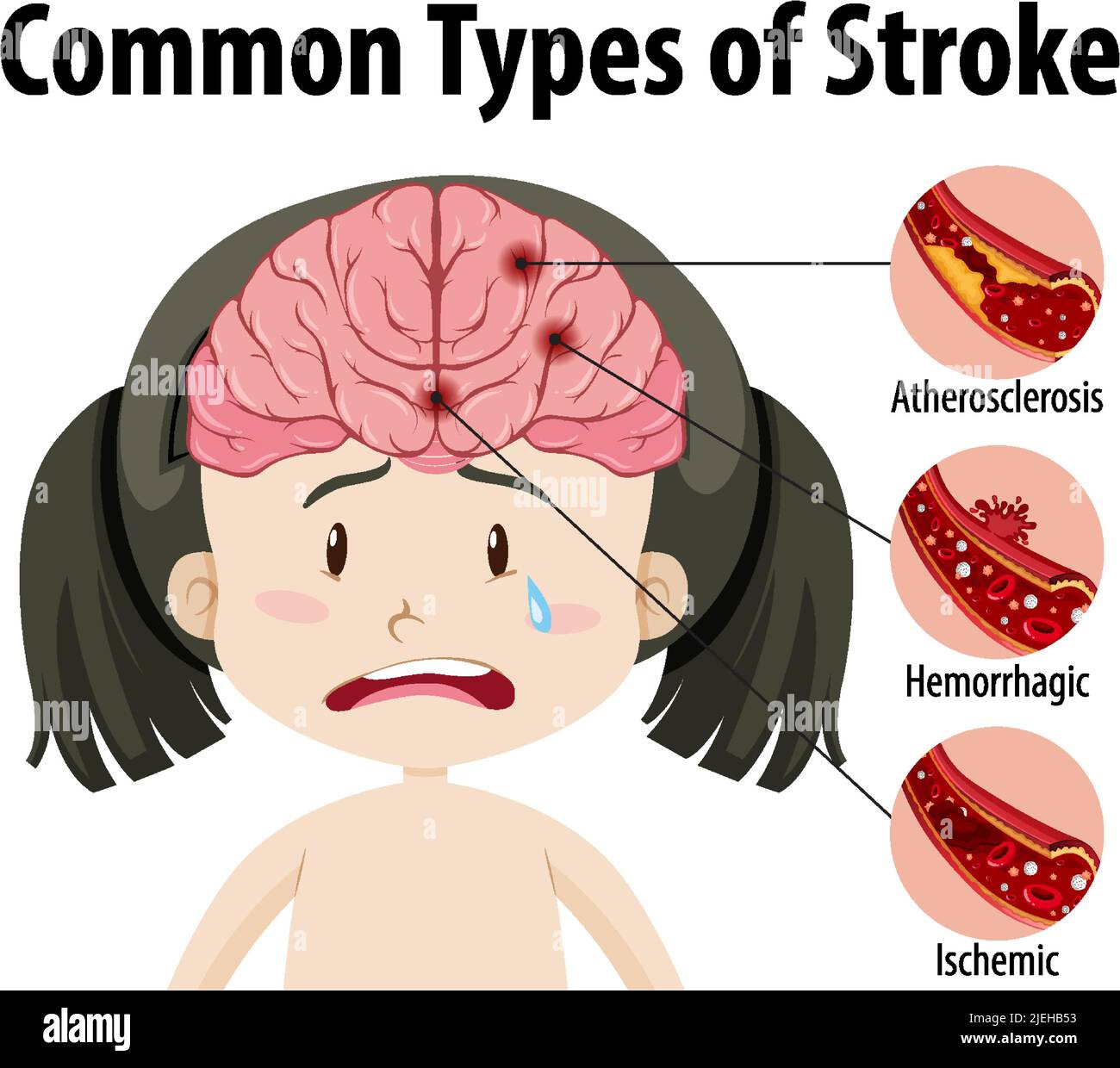 Human with common types of stroke illustration Stock Vector Image & Art ...