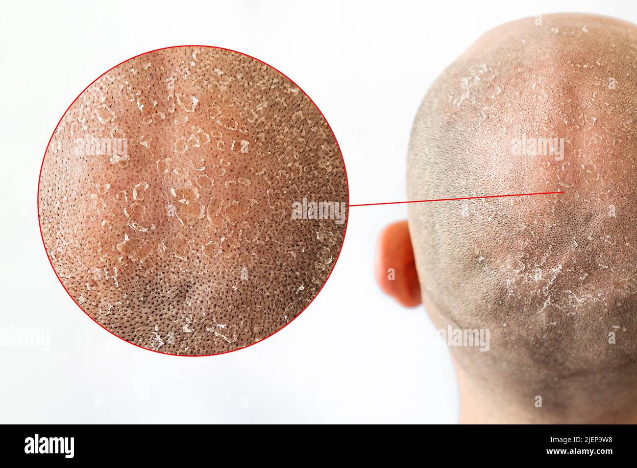 Male bald flaky head with dandruff close-up, back view. White ...