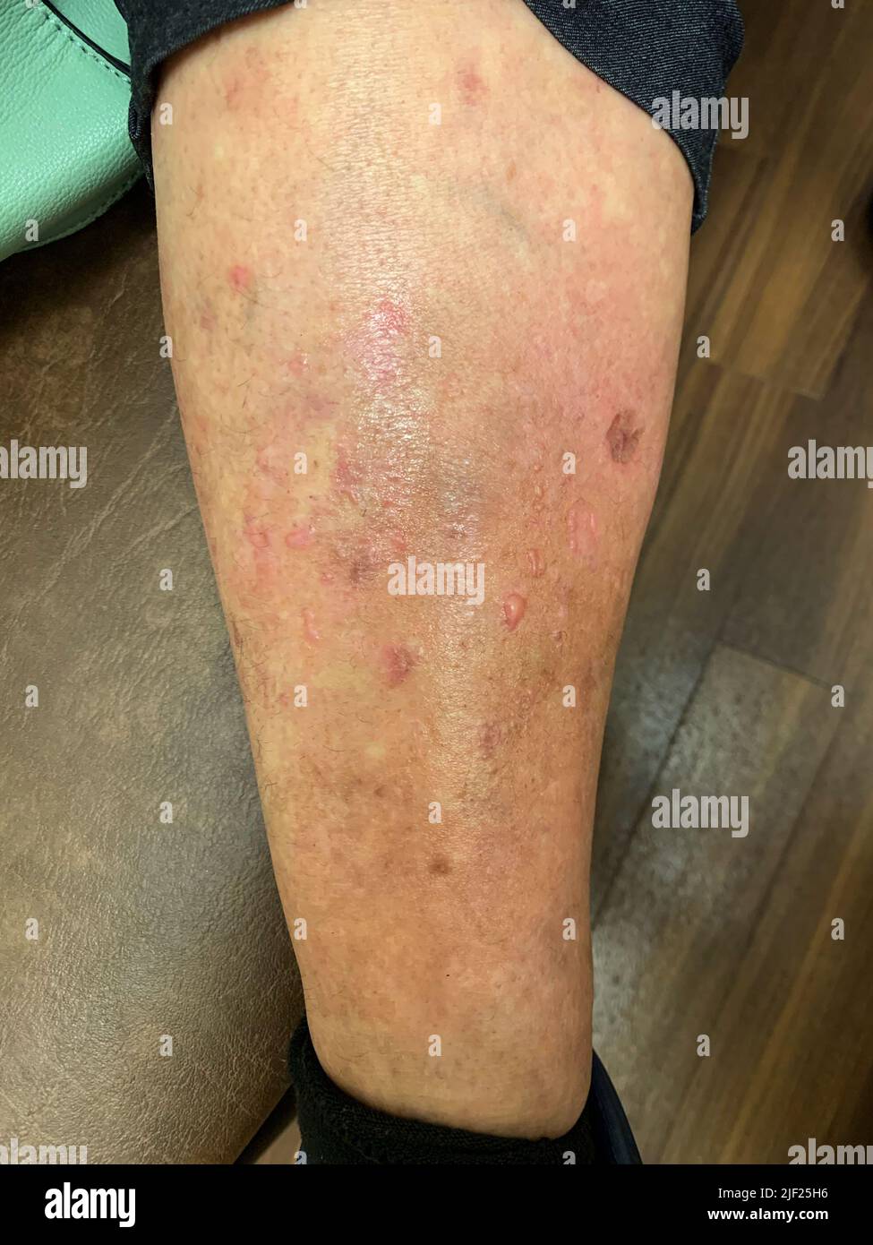 Linear immunoglobulin A (IgA) bullous dermatosis (LAD) in a Hispanic ...