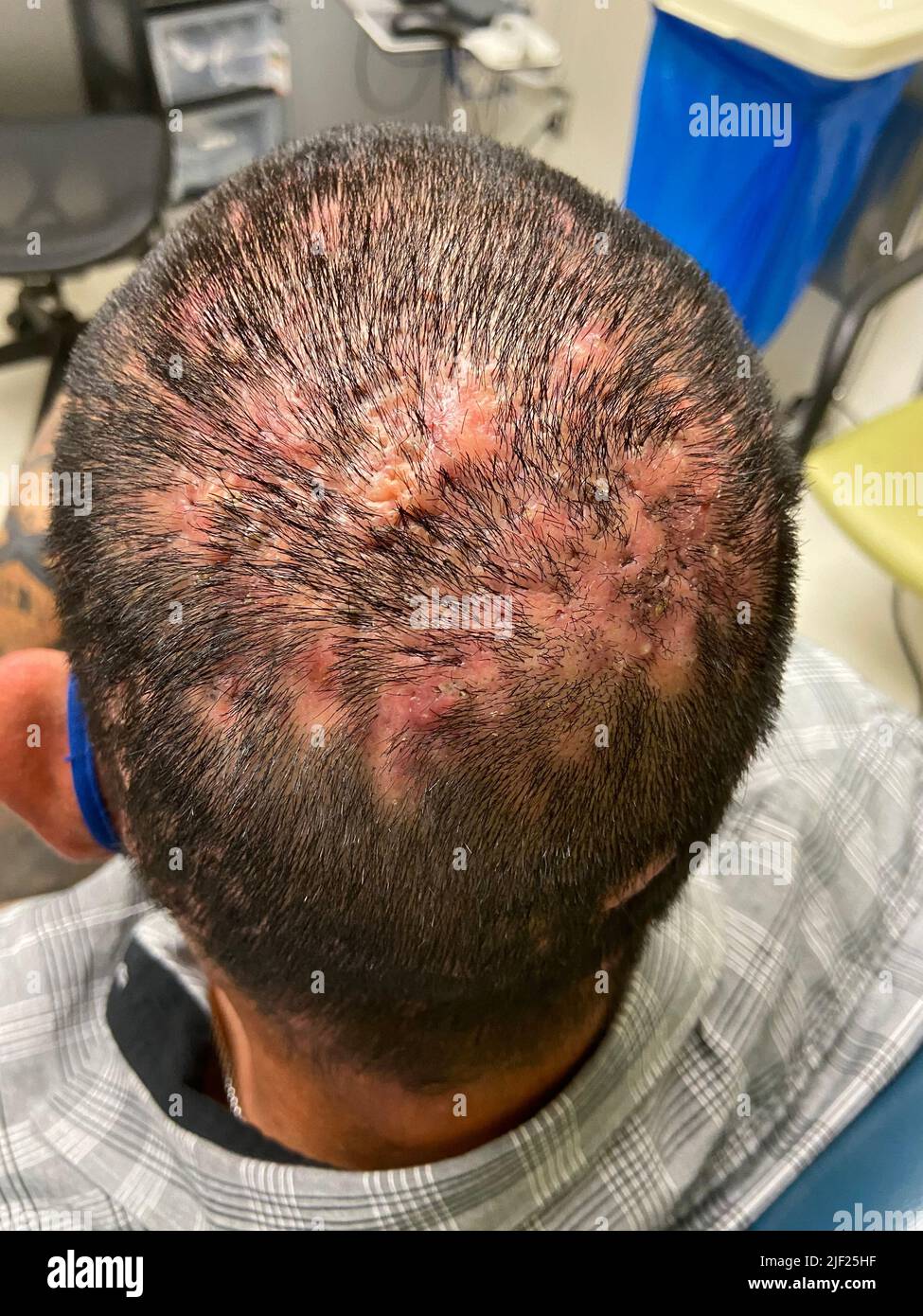Scalp Cellulitis