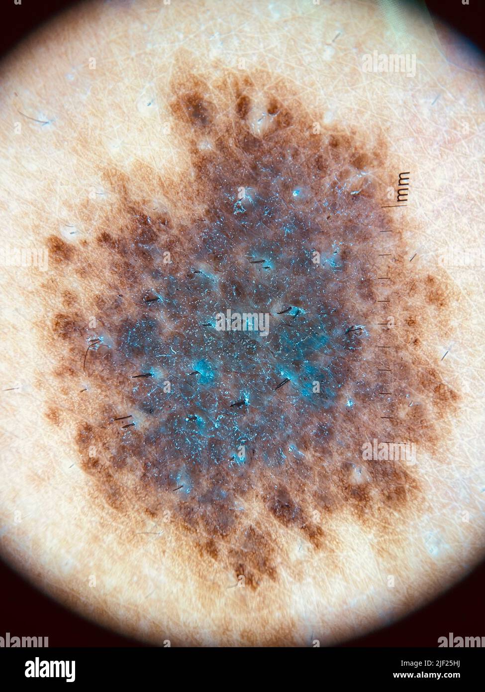 Dermatoscope image of a congenital naevus, or mole. This skin mark is ...