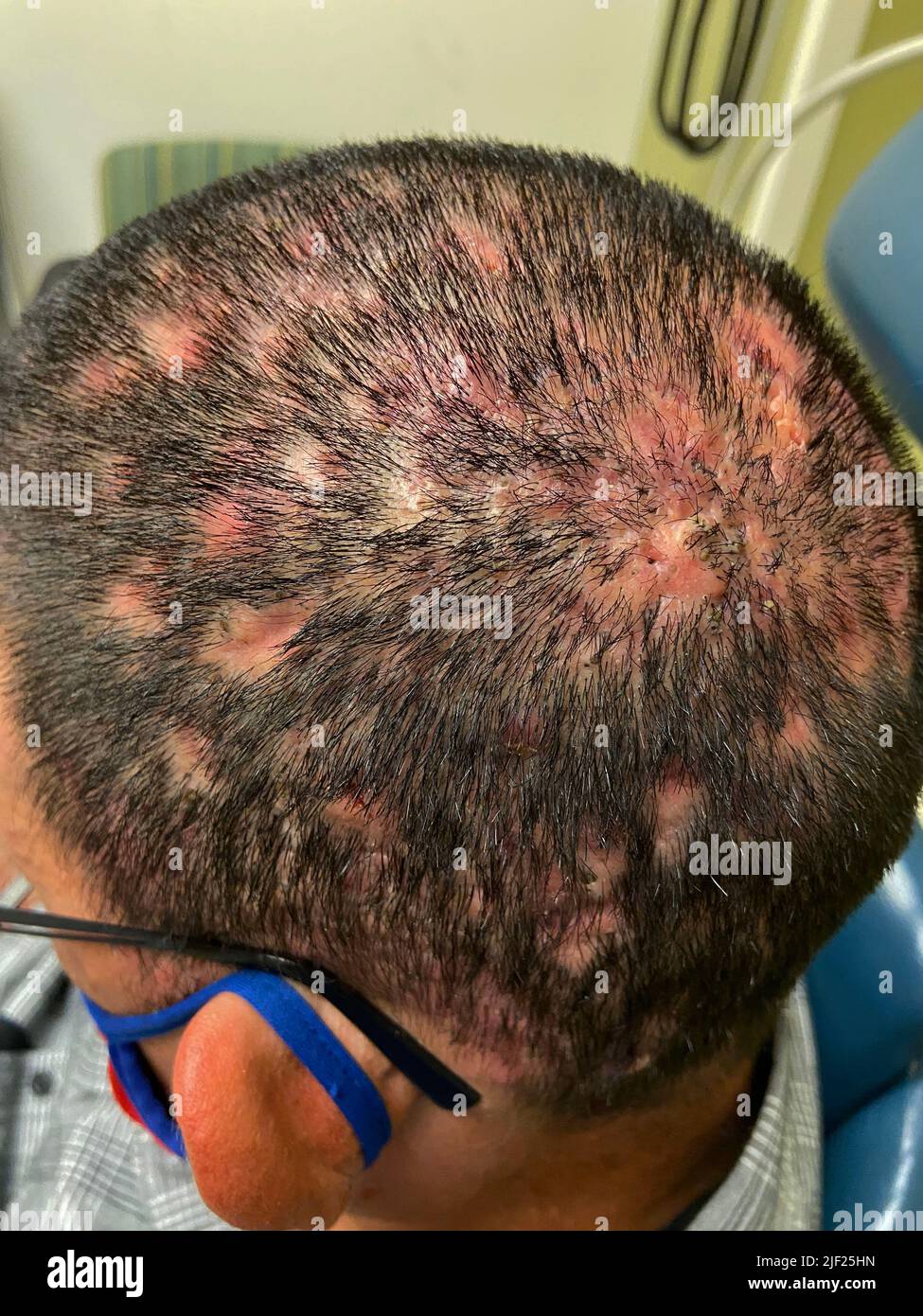 Scalp Cellulitis