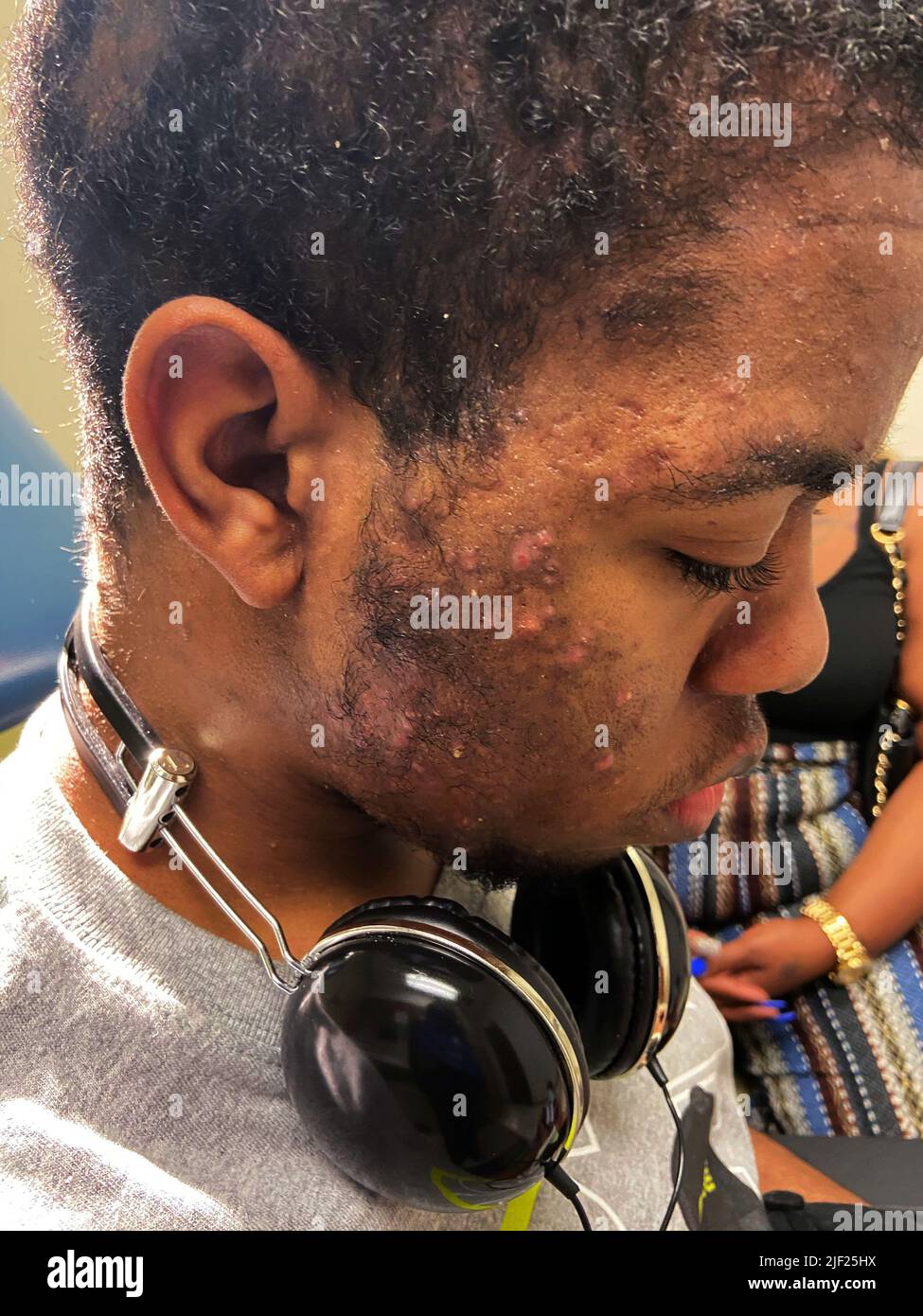 Dissecting cellulitis in an African American male patient. This ...