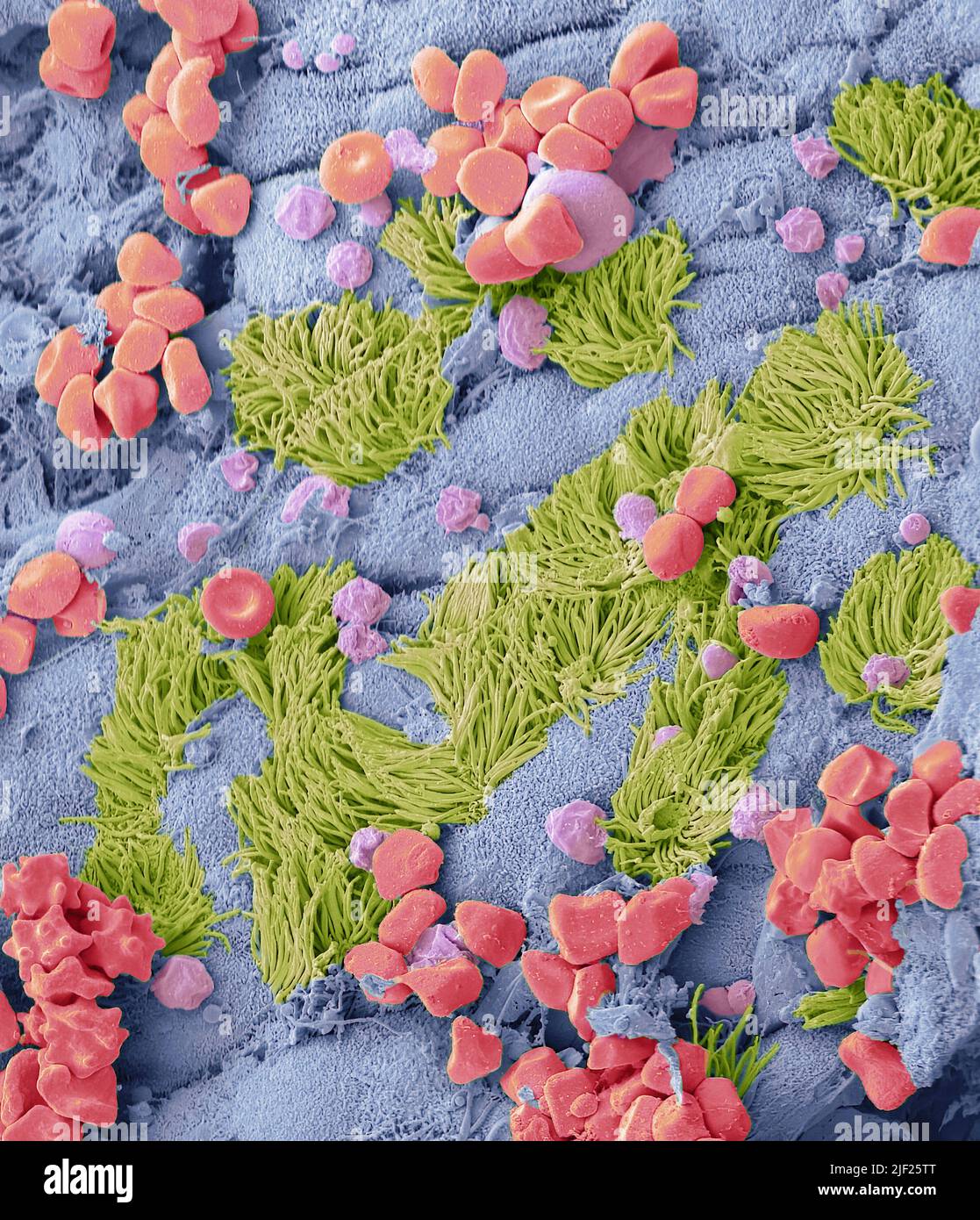 Hematosalpinx. Coloured scanning electron micrograph (SEM) of a freeze ...