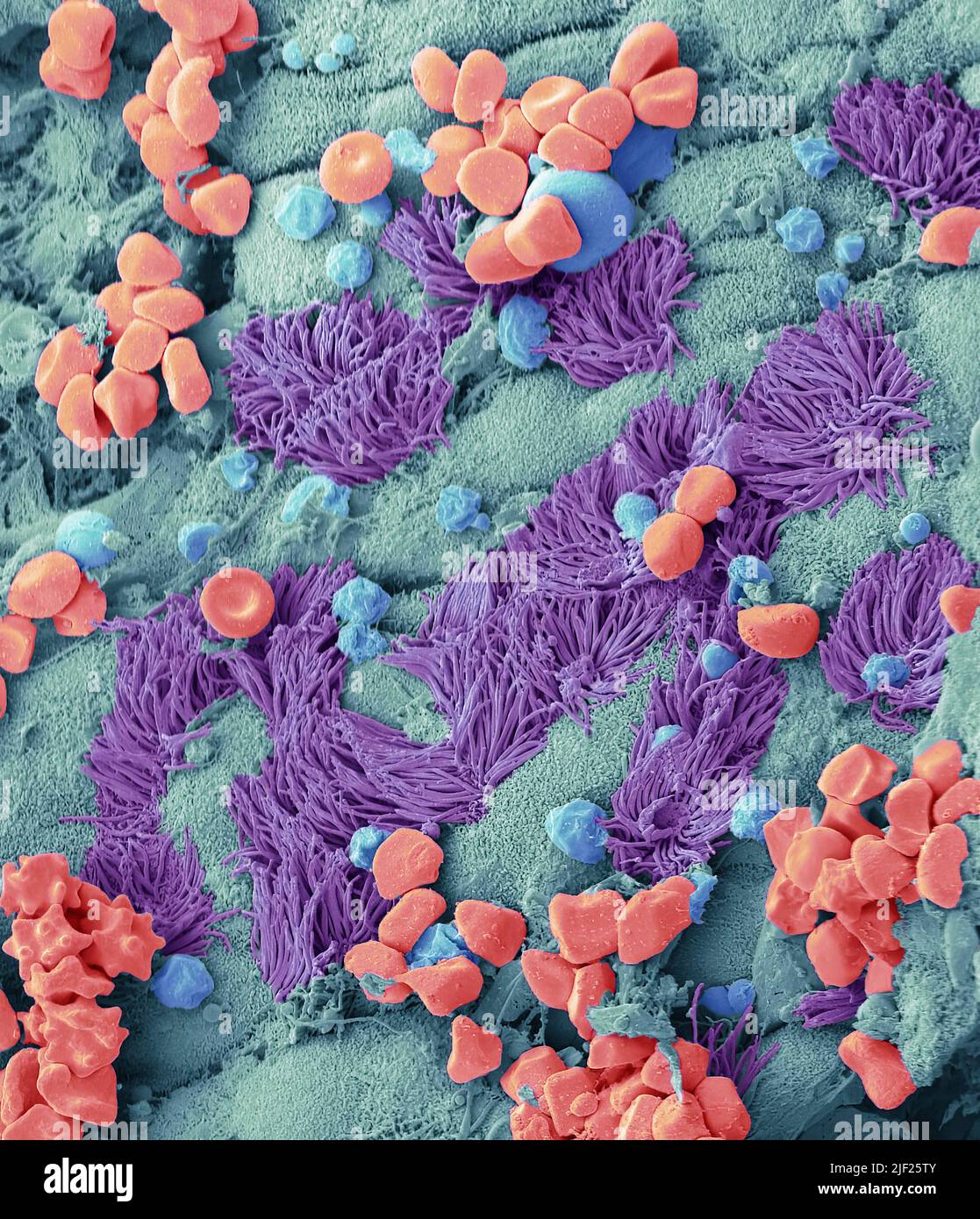 Hematosalpinx. Coloured scanning electron micrograph (SEM) of a freeze ...