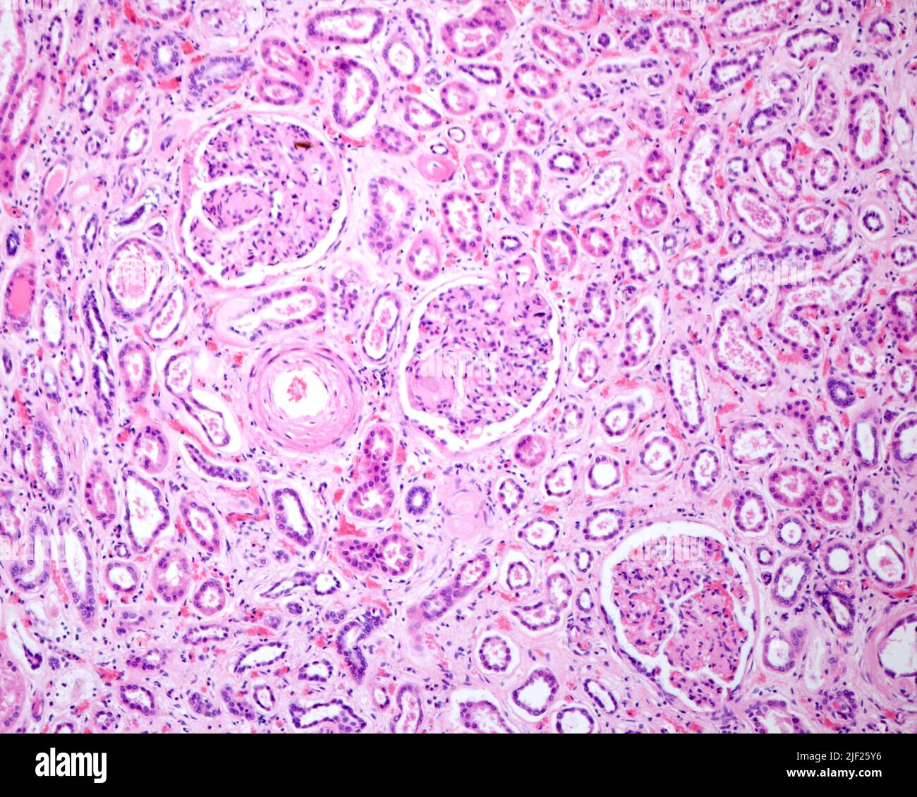 Light micrograph of a human kidney affected by an advanced diabetic ...