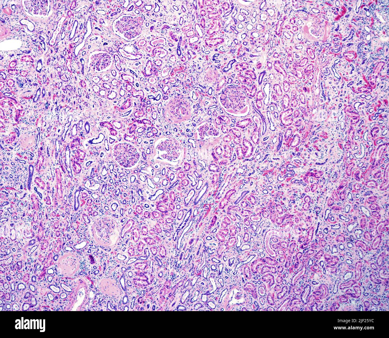 Light micrograph of a human kidney affected by an advanced diabetic ...