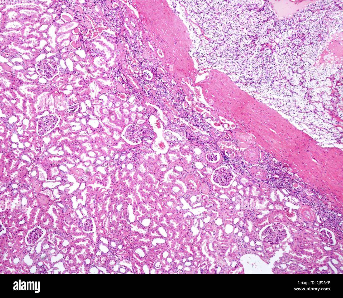 Human kidney. Light micrograph showing the border between a renal clear ...