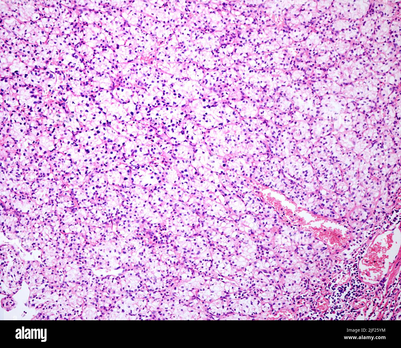 Light micrograph showing a renal clear cell carcinoma (RCC) nodule ...