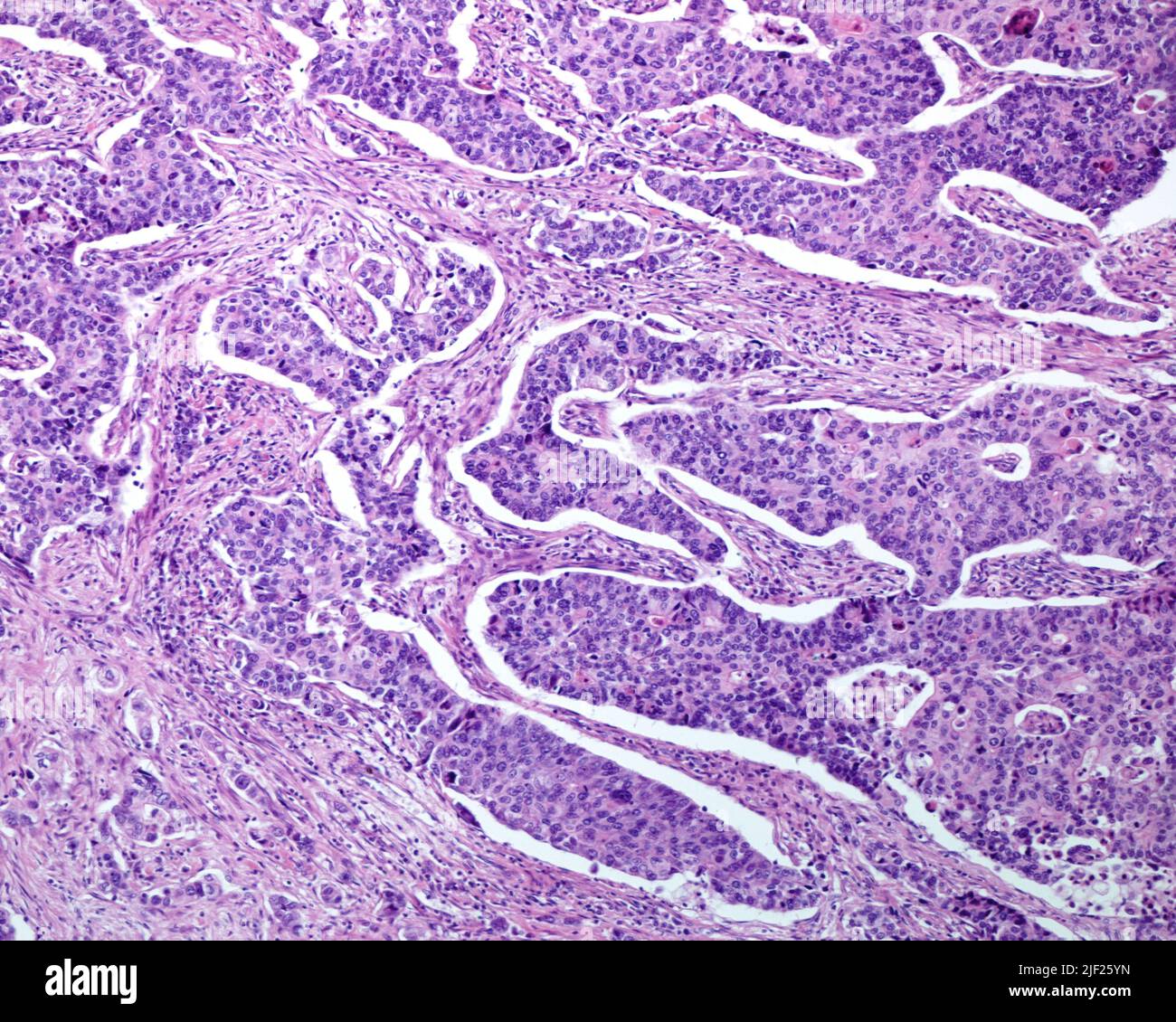 Stomach Cancer Cells