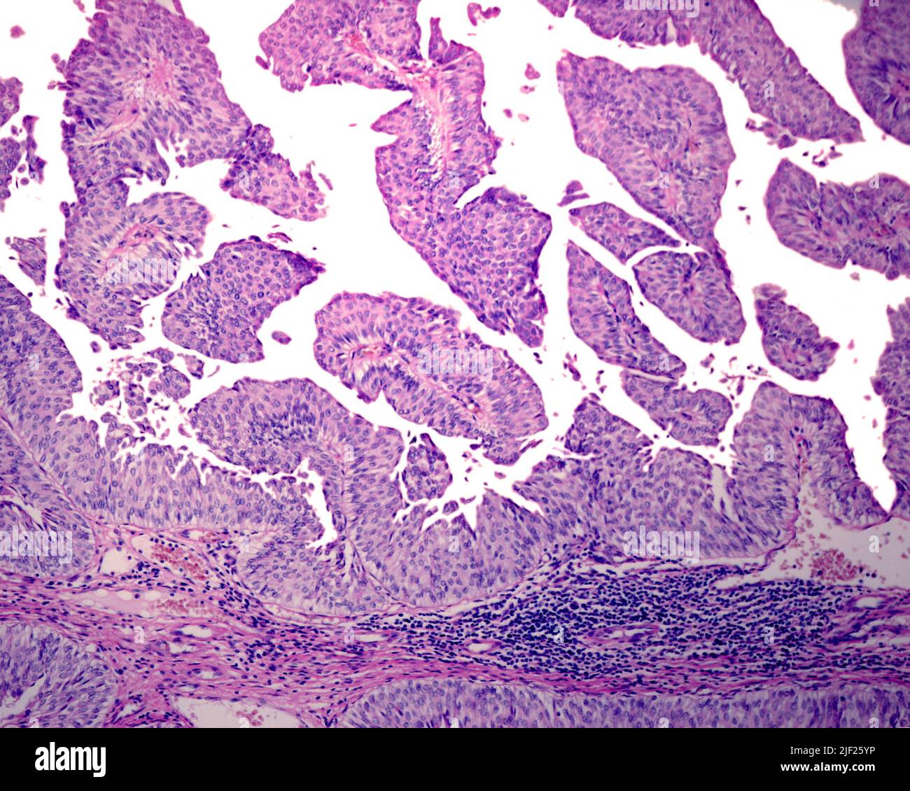 Light micrograph of a low grade papillary carcinoma (urothelial ...