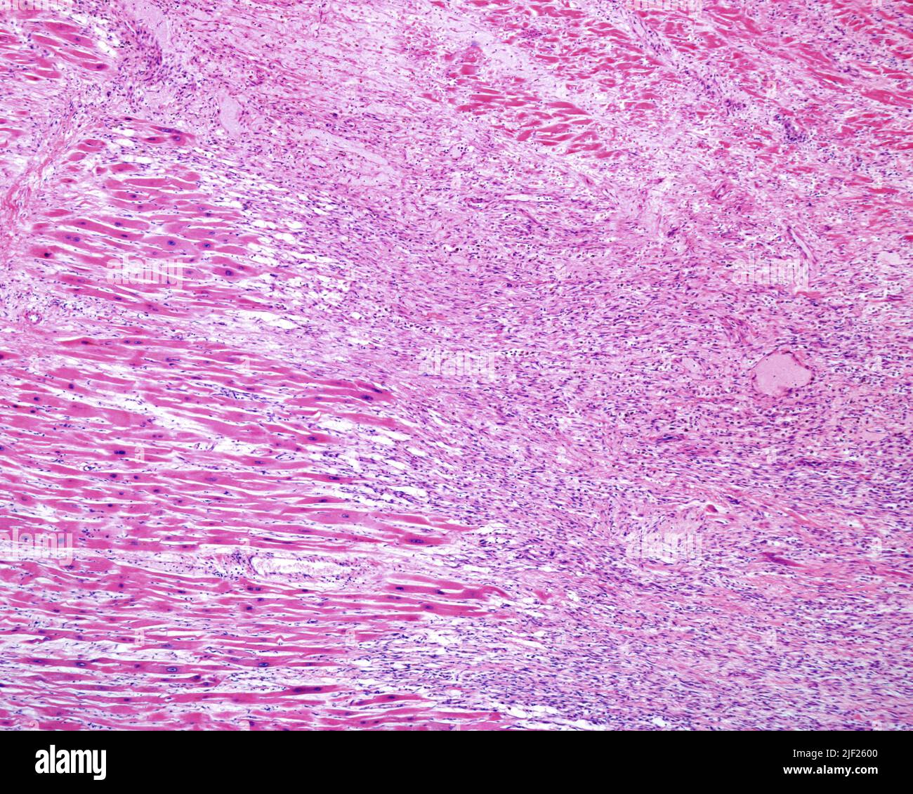 Light Micrograph Of A Fibrotic Scar From An Old Myocardial Infarct In A Light Micrograph Of A Fibrotic Scar From An Old Myocardial Infarct In A