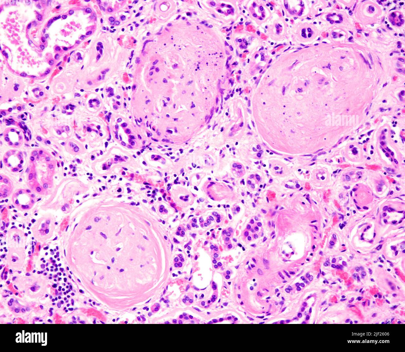 Light micrograph of a human kidney affected by an advanced diabetic ...