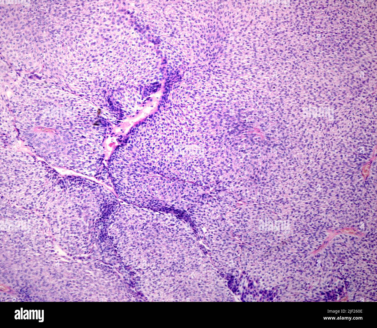 Light micrograph of a solid papillary carcinoma in a human urinary ...