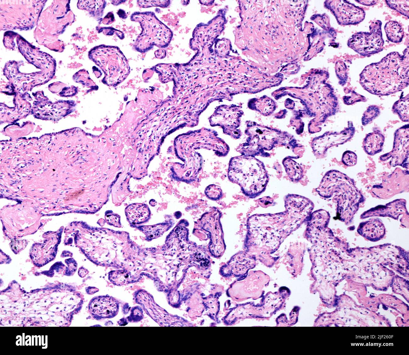 Human placenta. Erythroblastosis fetalis. Seen is a placental villus ...