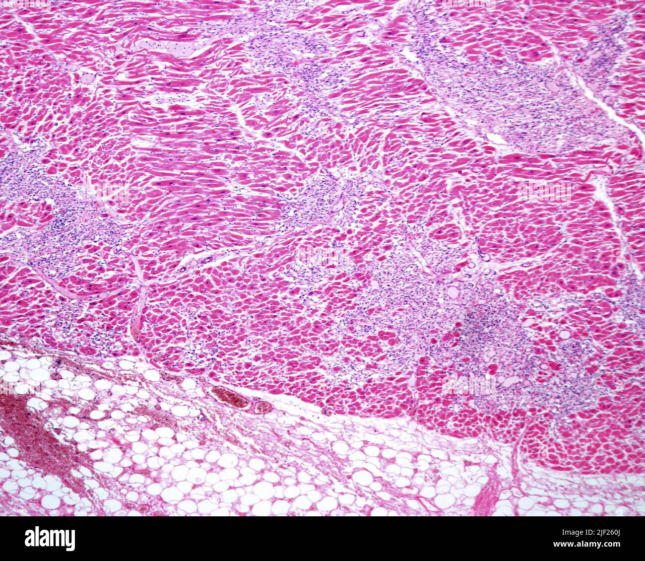 Light micrograph of a fibrotic scar from an old myocardial infarct in a ...