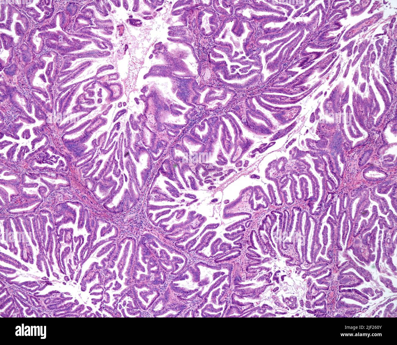 Light micrograph of endometroid carcinoma showing a complex papillary ...