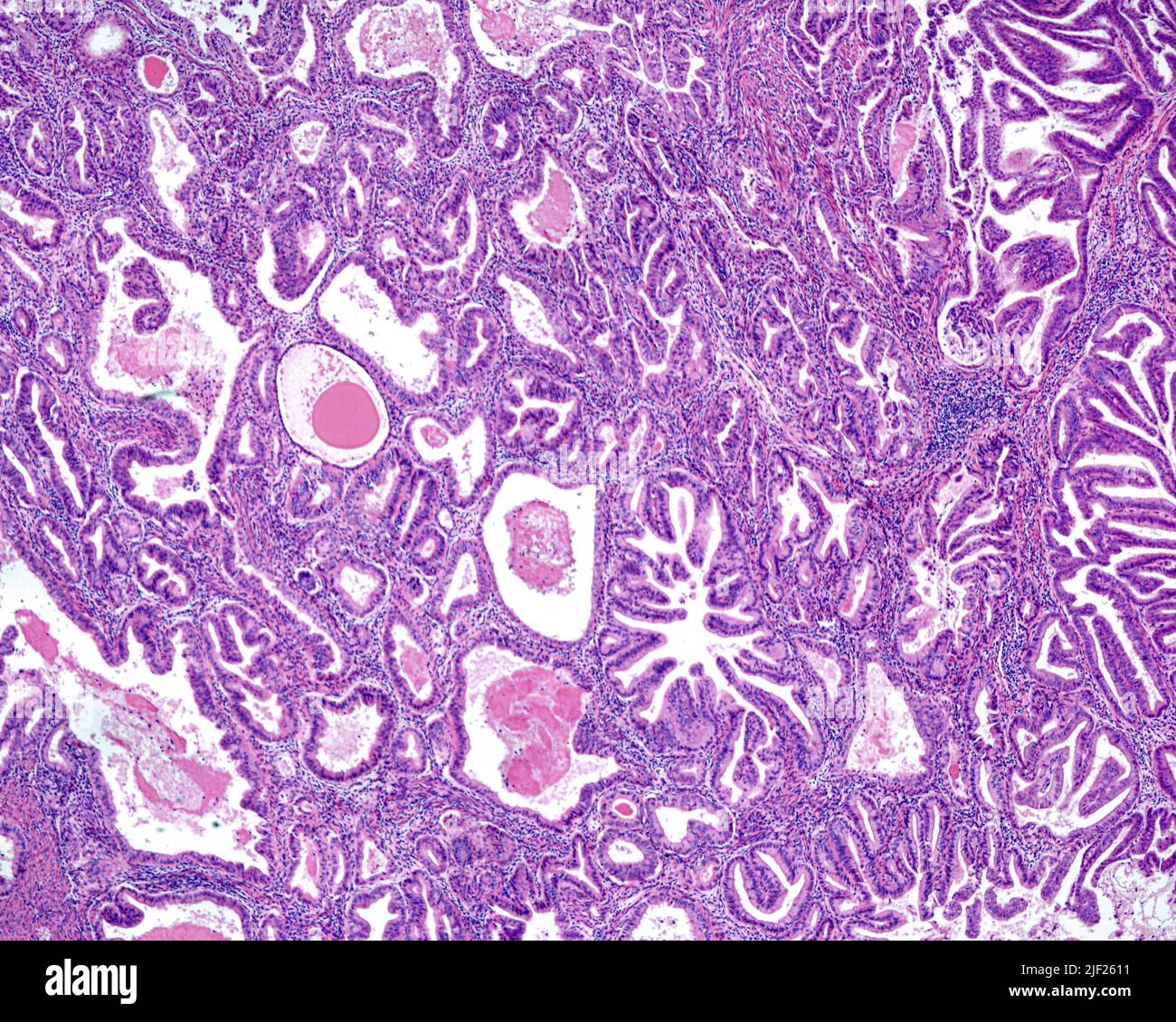Light micrograph of endometroid carcinoma showing a complex papillary ...