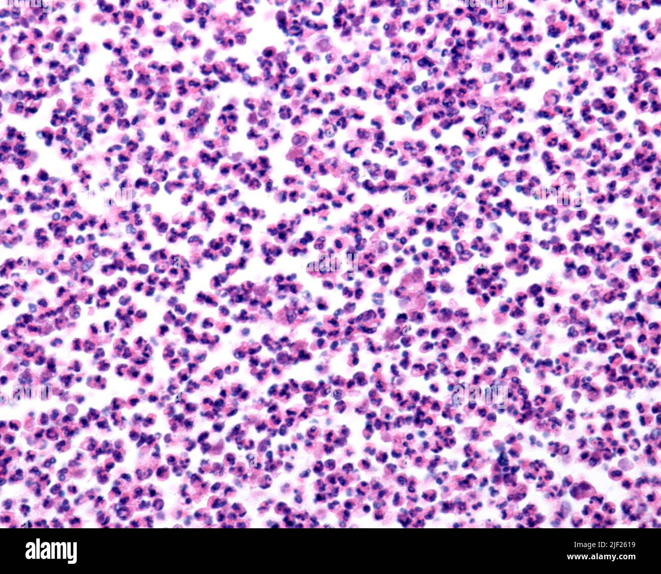 Light micrograph of pus. Pus is an accumulation of cells, white blood ... Light micrograph of pus. Pus is an accumulation of cells, white blood ...