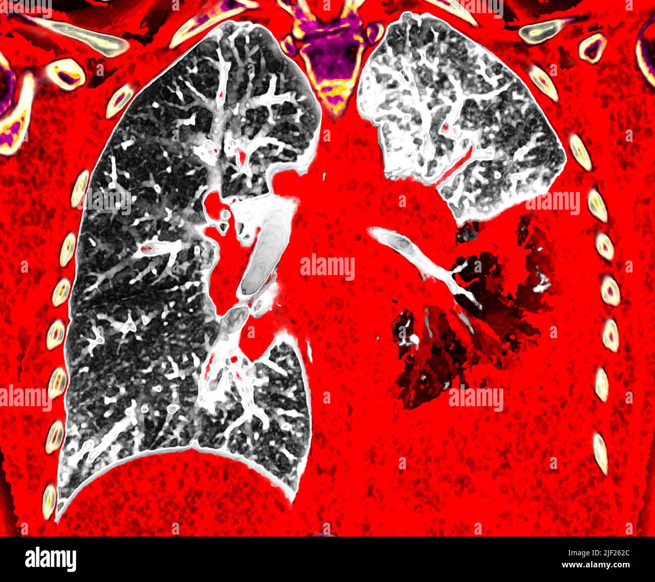 Coloured computed tomography (CT) scan of the chest of a patient with ...