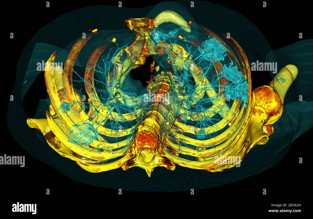 Coloured 3D computed tomography (CT) scan of human lungs affected by ...