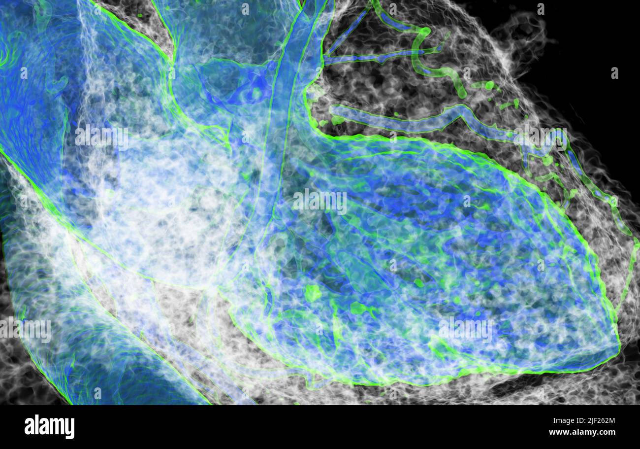 Coloured 3D computed tomography (CT) angiogram scan showing atheromatous plaques in the coronary ...