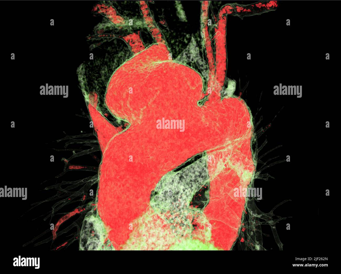 Coloured 3D computed tomography (CT) scan showing an aneurysm (swelling, upper centre) in the ...