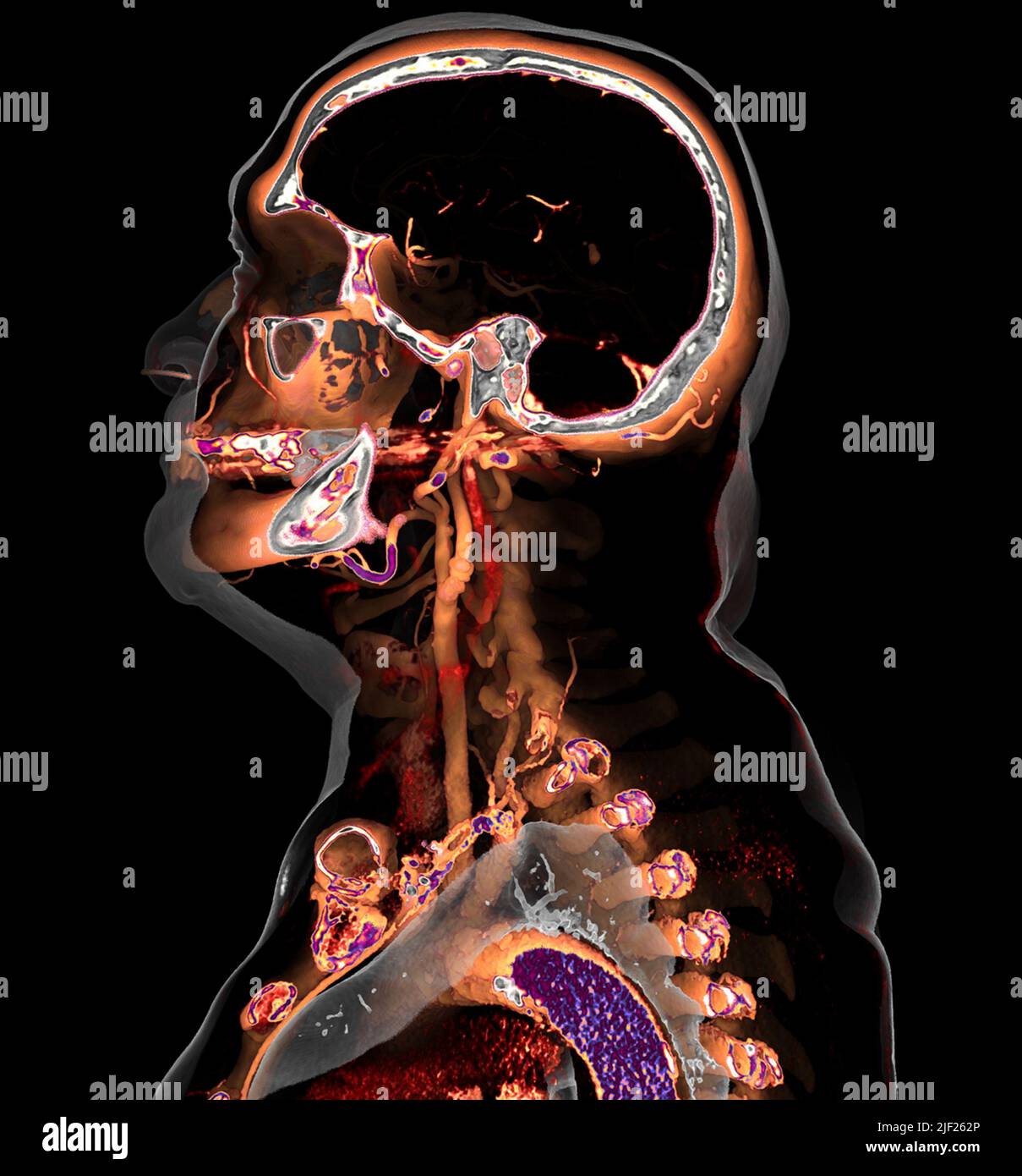 Coloured 3D computed tomography (CT) angiogram scan showing carotid arteries affected by ...