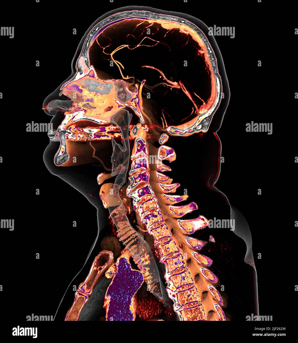 Coloured 3D computed tomography (CT) angiogram scan showing carotid arteries affected by ...
