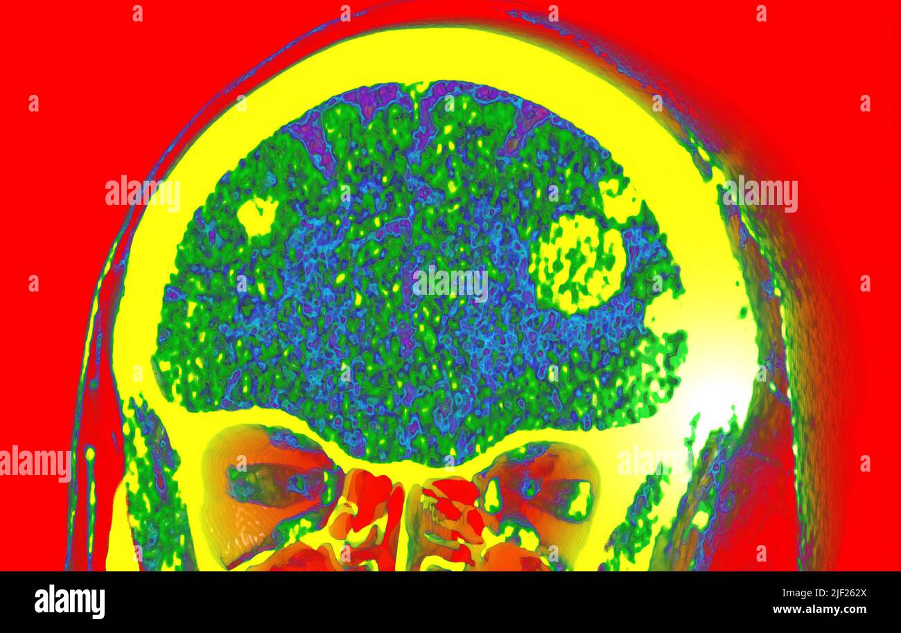 Coloured Computed Tomography Ct Scan Showing Secondary Malignant