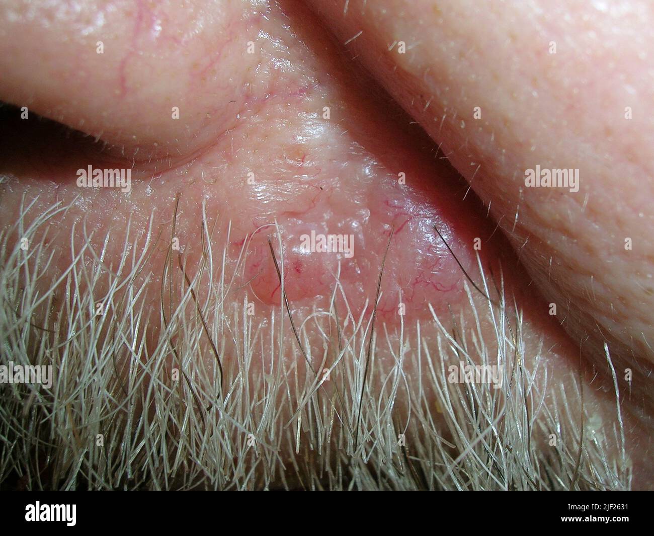 Basal cell carcinomas (BCC), or rodent ulcers, on the face of a white ...