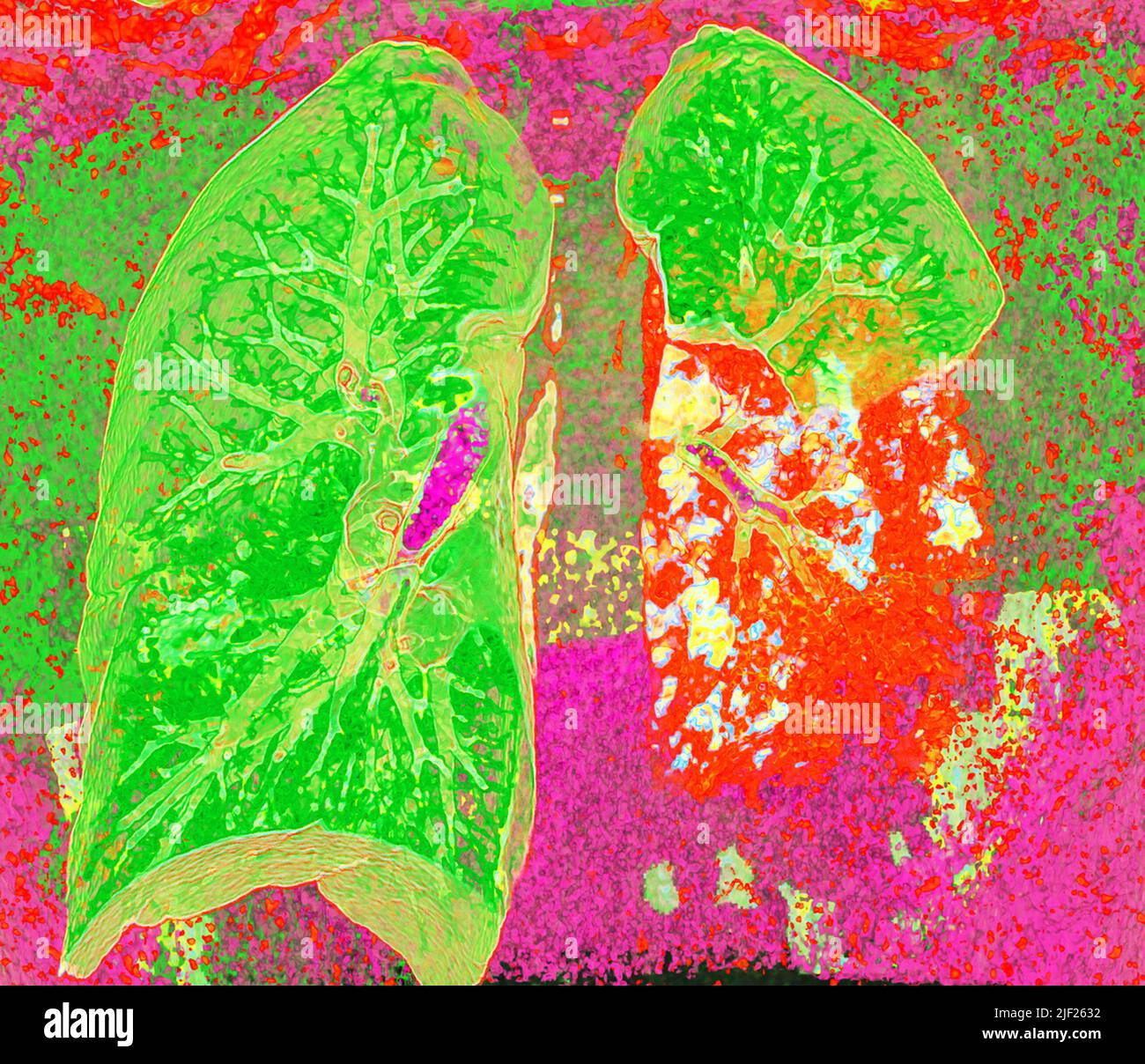 Coloured computed tomography (CT) scan of the chest of a patient with ...