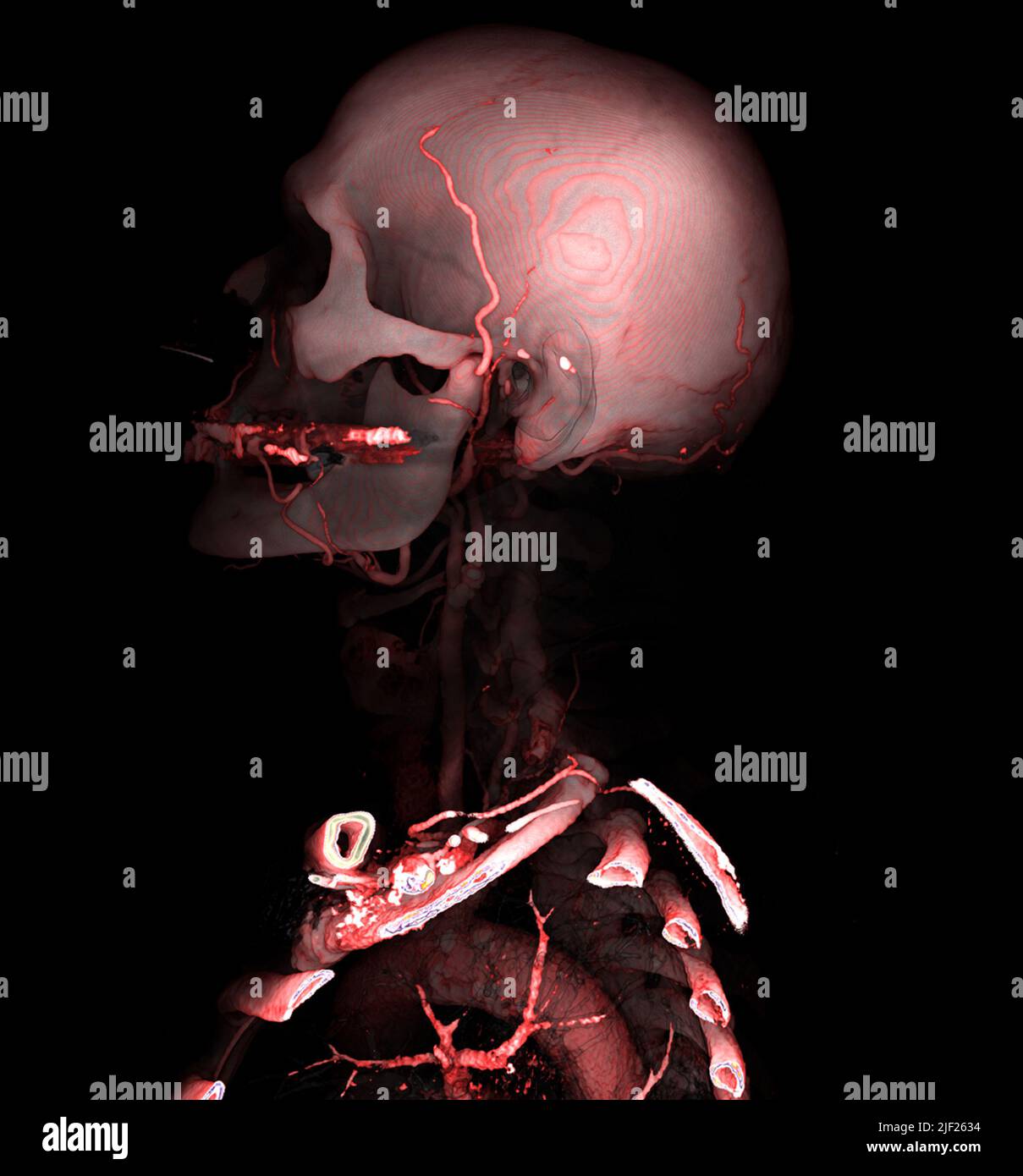 Coloured 3D computed tomography (CT) angiogram scan showing carotid arteries affected by ...