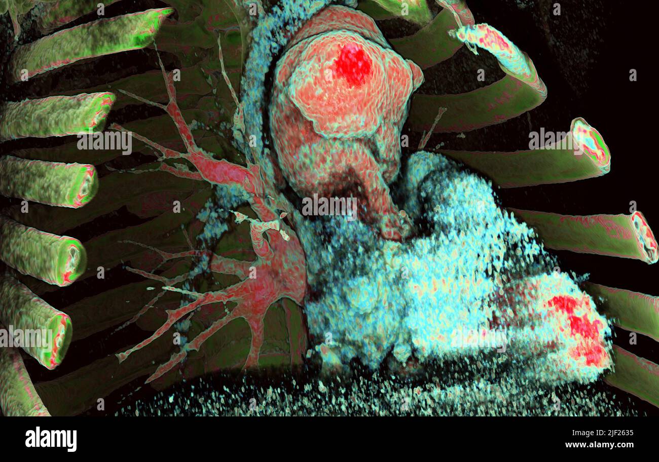 Coloured 3D computed tomography (CT) scan showing an aneurysm (swelling, top centre) in the ...