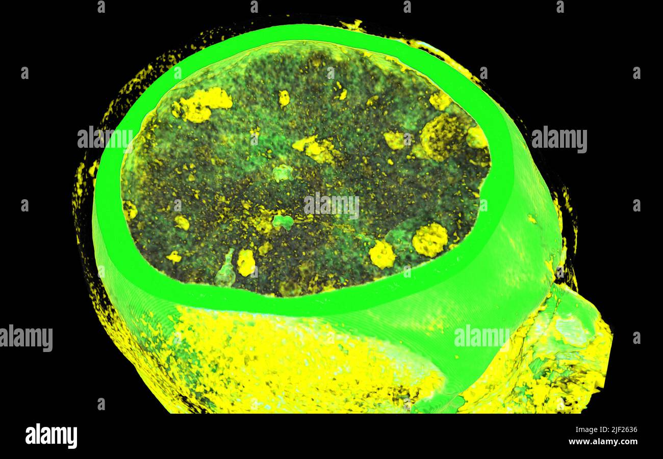 Coloured computed tomography (CT) scan showing secondary malignant (cancerous) tumours (yellow ...