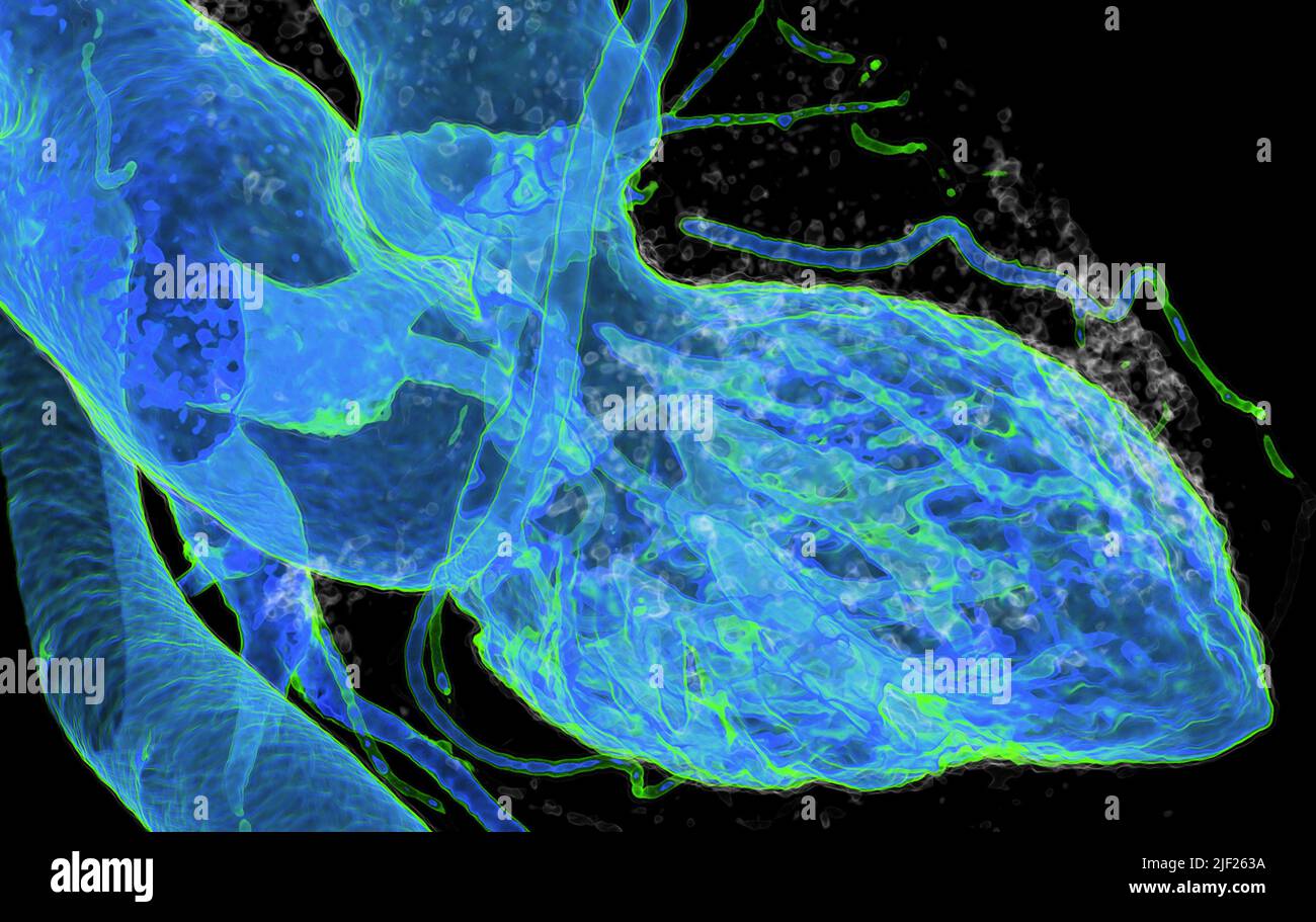Coloured 3D computed tomography (CT) angiogram scan showing atheromatous plaques in the coronary ...