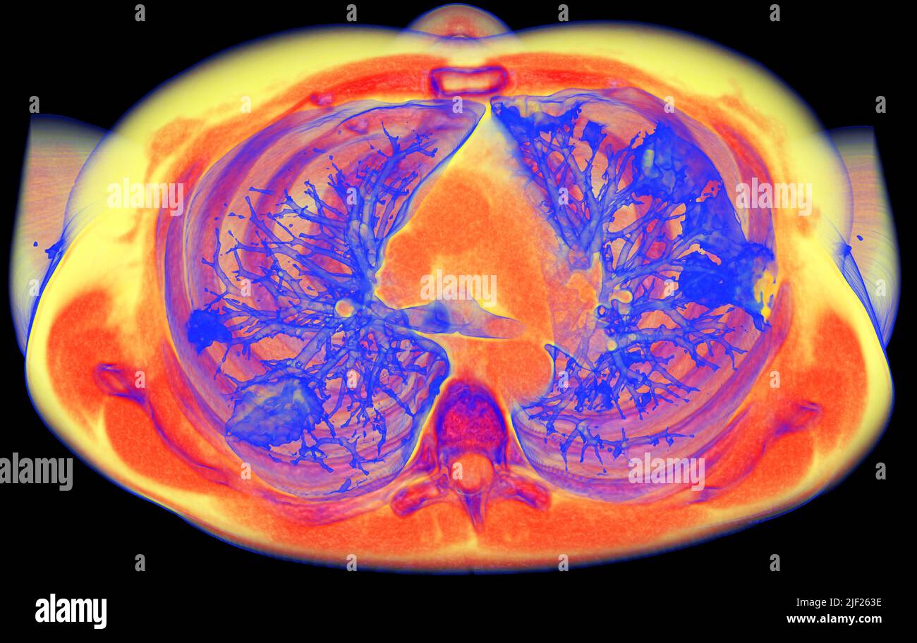 Coloured 3D computed tomography (CT) scan of human lungs affected by Covid-19 pneumonia. Covid ...