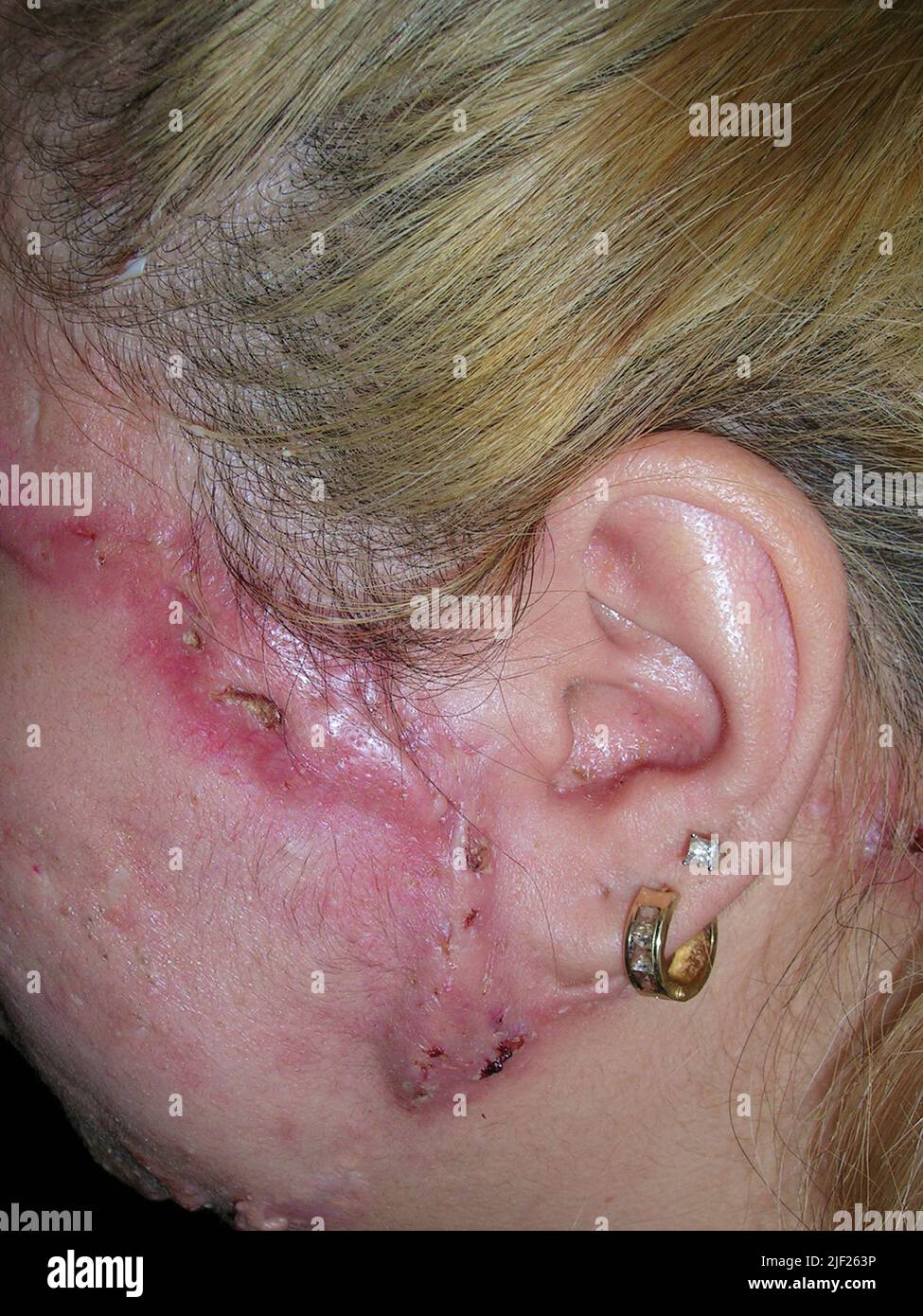 Pyoderma gangrenosum on a female patient's face. This disease causes ...