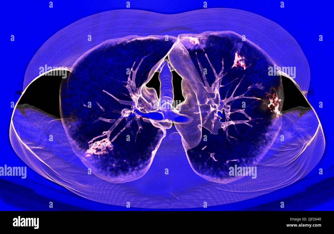Coloured 3D computed tomography (CT) scan of human lungs affected by ...