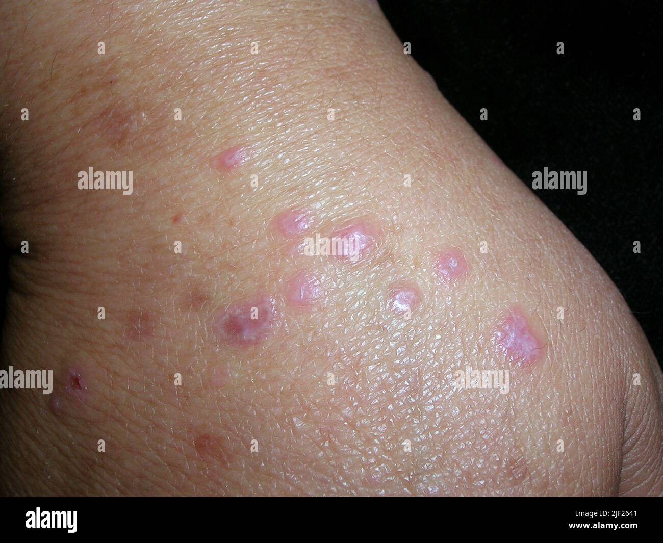 Lichen planus. Lichen planus is an inflammatory disorder of the skin ...