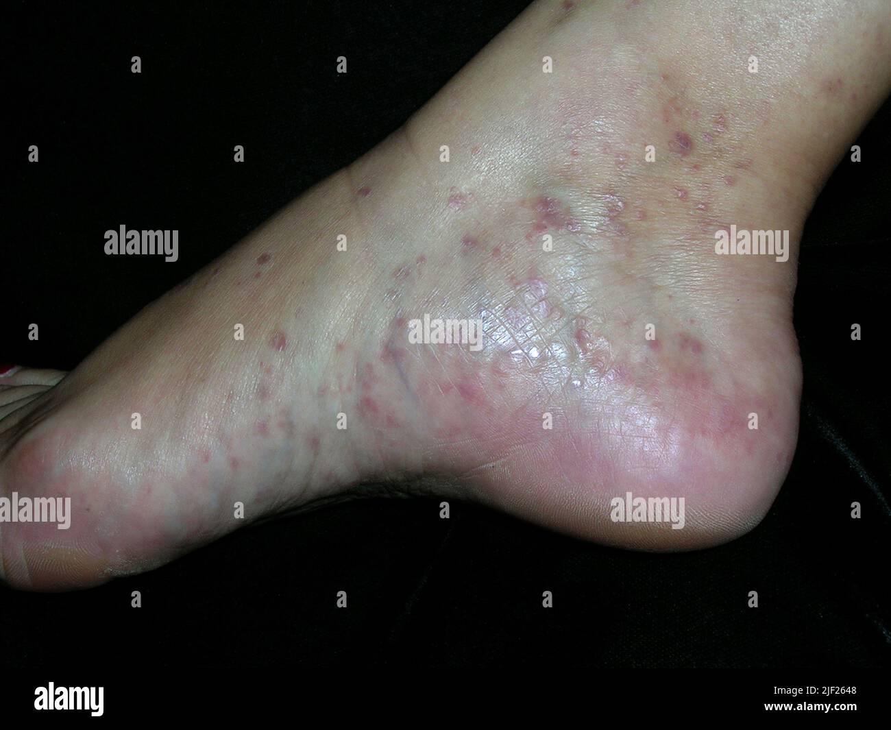 Lichen planus in a 49 year old Hispanic female. Lichen planus is an ...